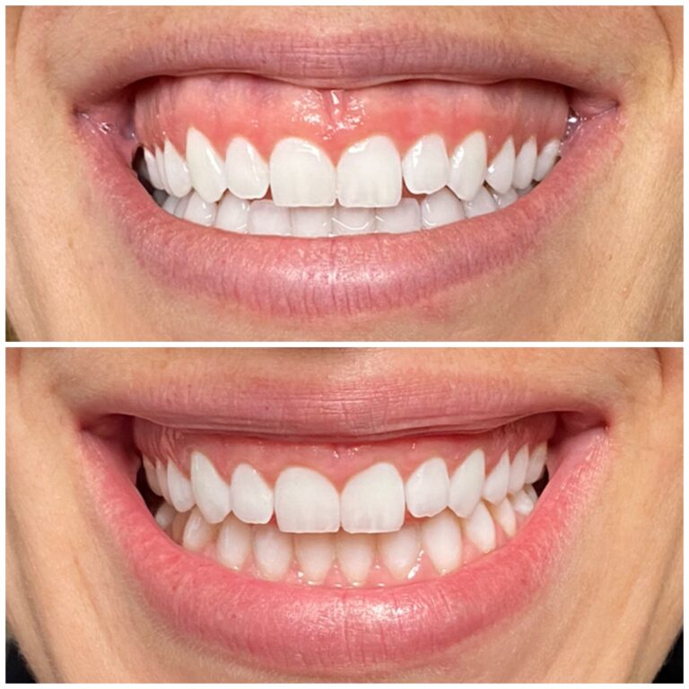 Is a BOTOX Lip Flip Right for You? | The Lumen Center Phildelphia