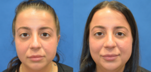 Buccal Fat Removal Philadelphia , PA - The Lumen Center