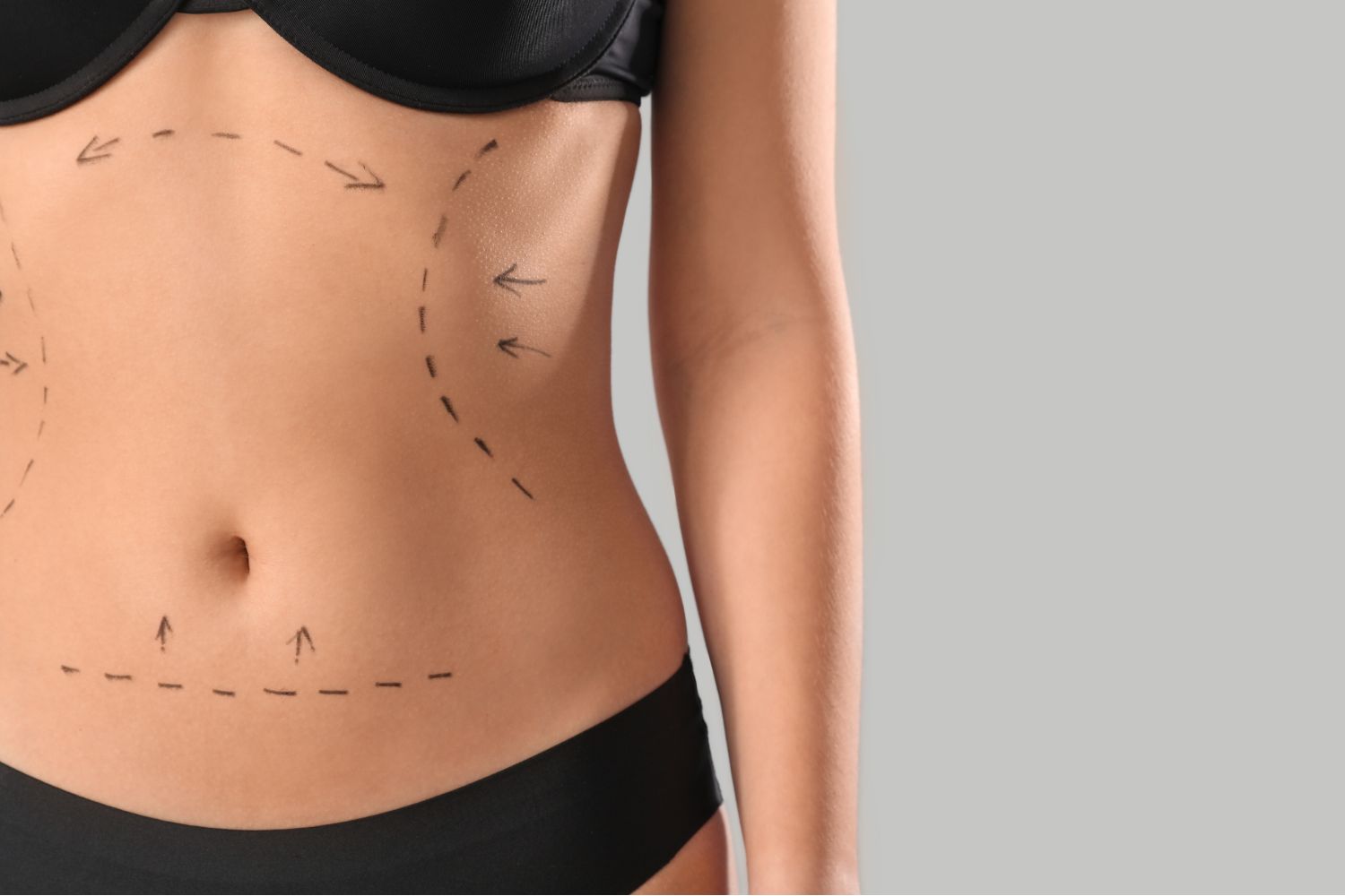 Liposuction: A Comprehensive Guide to Full-Body Contouring